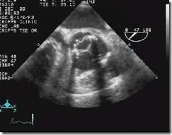 Edwards Lifesciences Receives FDA Approval For Magna Ease Aortic Valve ...